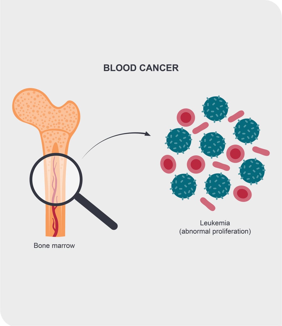 AML Drug Development | Crown Bioscience