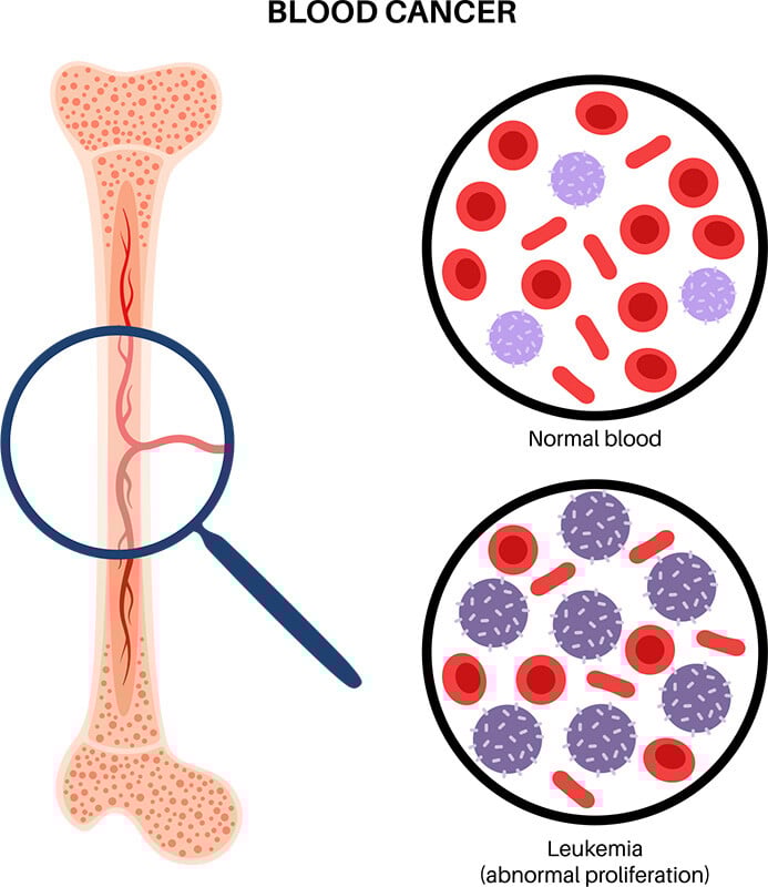 AML Drug Development | Crown Bioscience