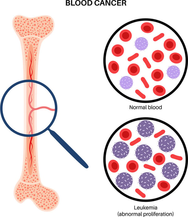AML Drug Development | Crown Bioscience